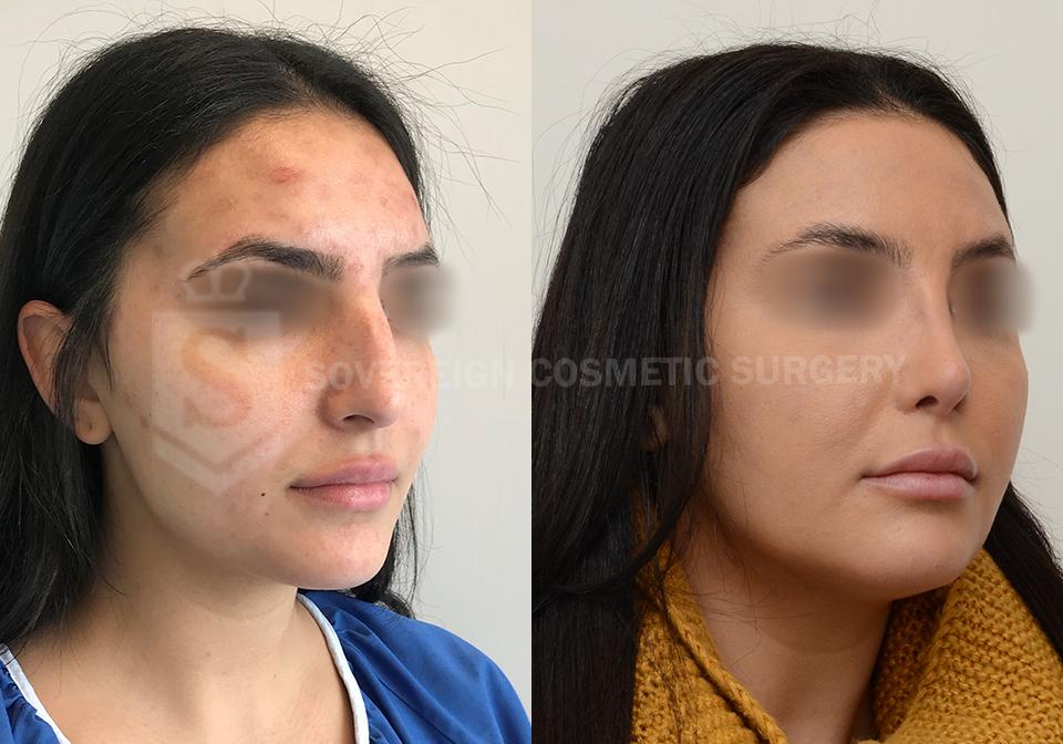 Before & After Gallery at Sovereign Cosmetic Surgery Clinic in Toronto