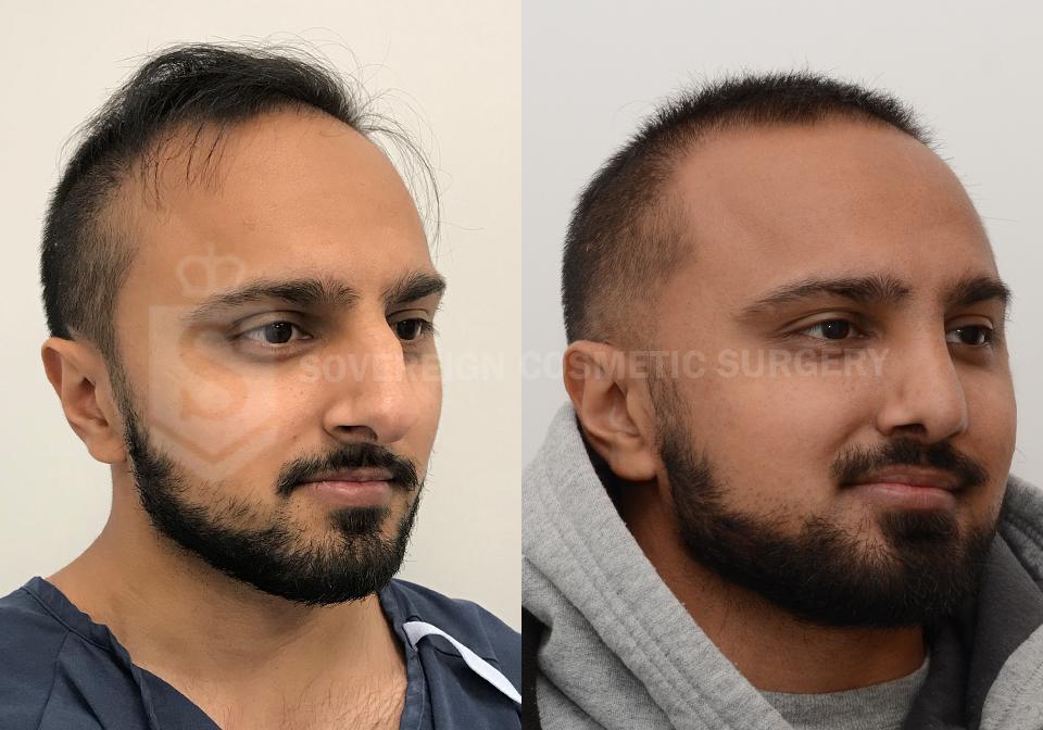 Before & After Gallery at Sovereign Cosmetic Surgery Clinic in Toronto